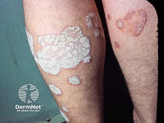 FDA Approves Icotrokinra, First Oral IL-23 Receptor Blocker for ...
