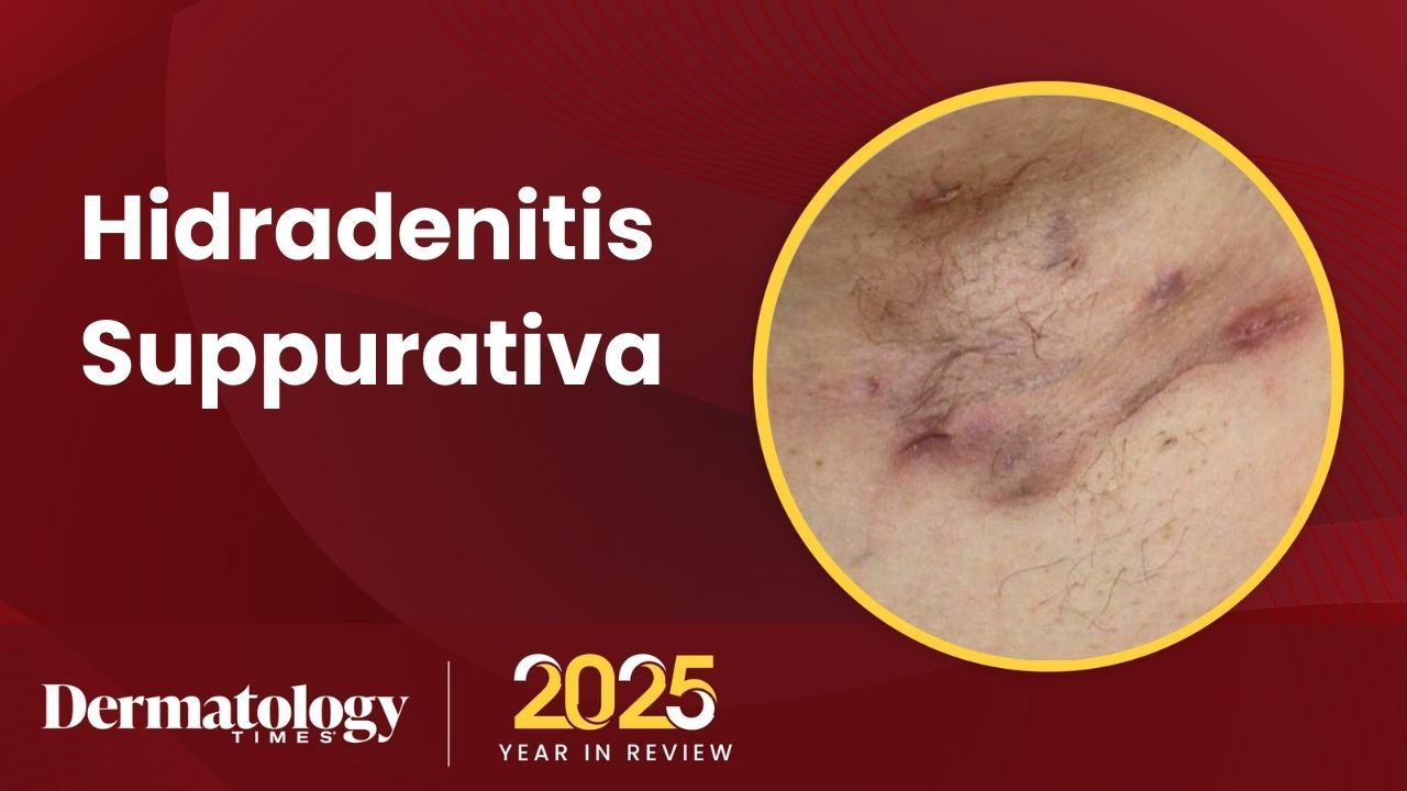 Dermatology Times 2025 Year in Review: Hidradenitis Suppurativa ...