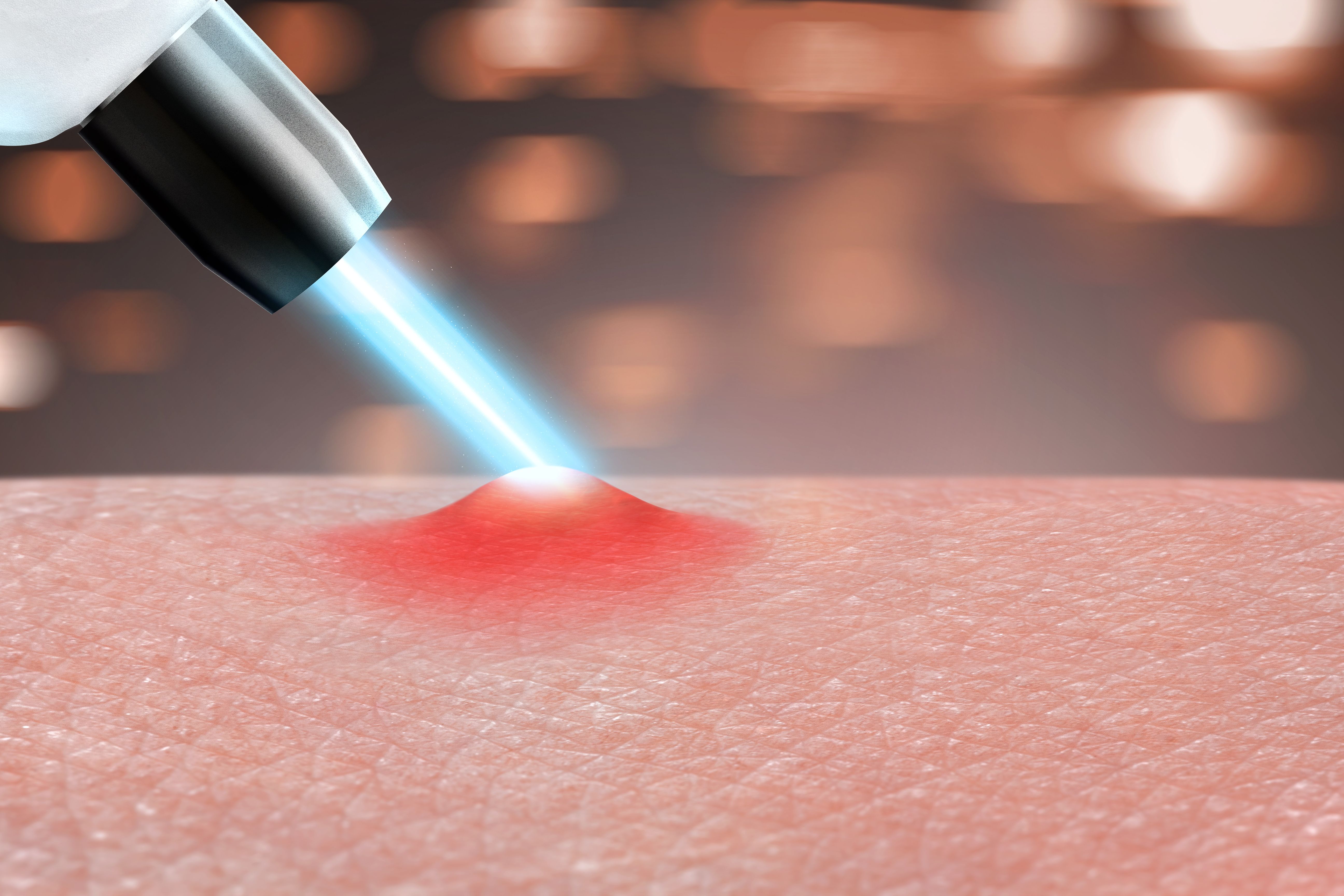 Rejuvenating Laser Leads to Acne Agminate-Like Reaction