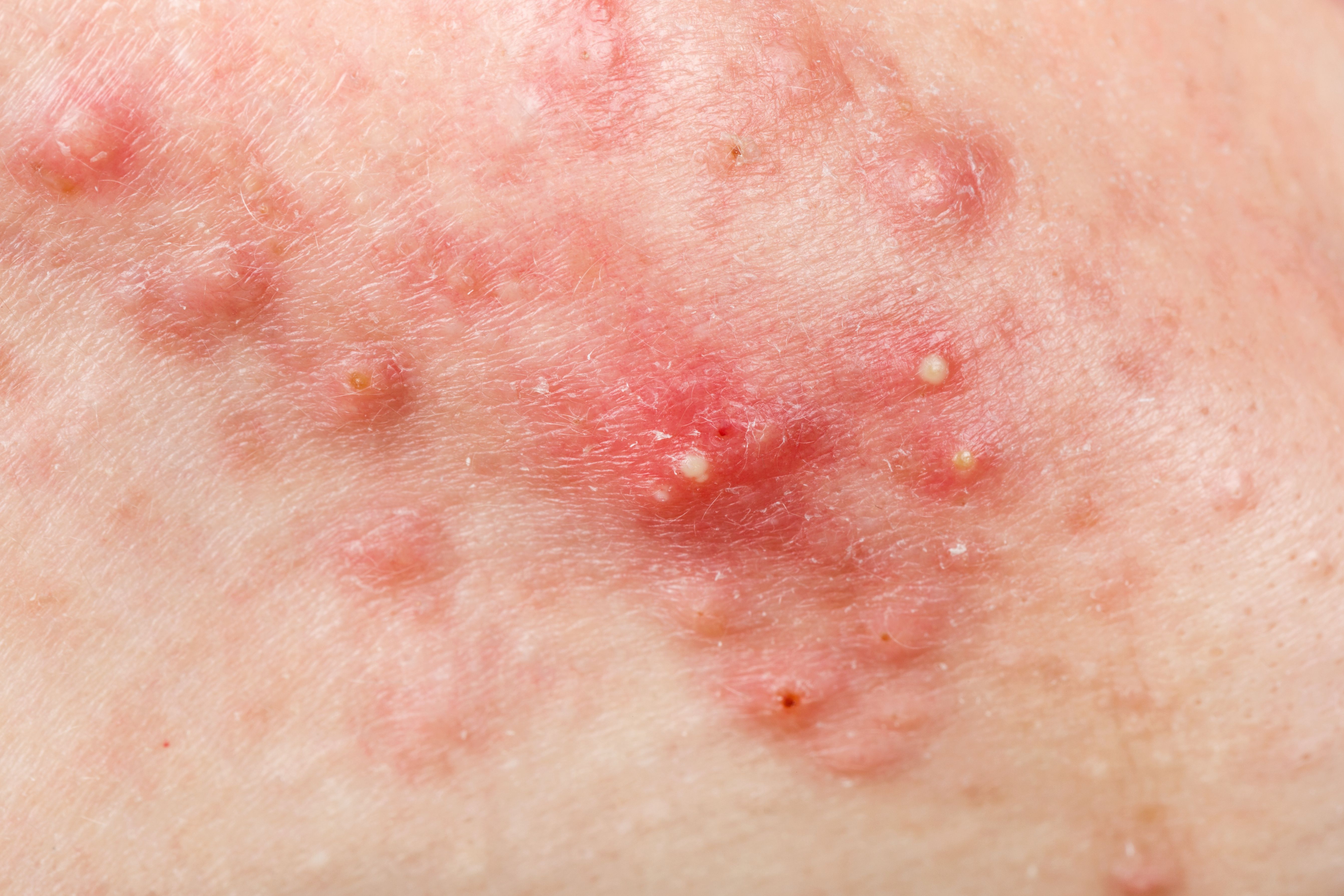 Patients With Acne Vulgaris Exhibit Lower Levels of Serum Zinc ...