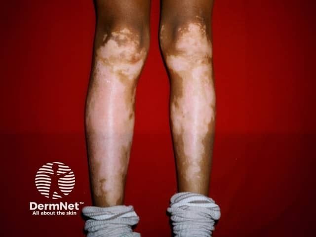 Phase 3 Data Show Upadacitinib Drives Progressive Repigmentation in Non ...
