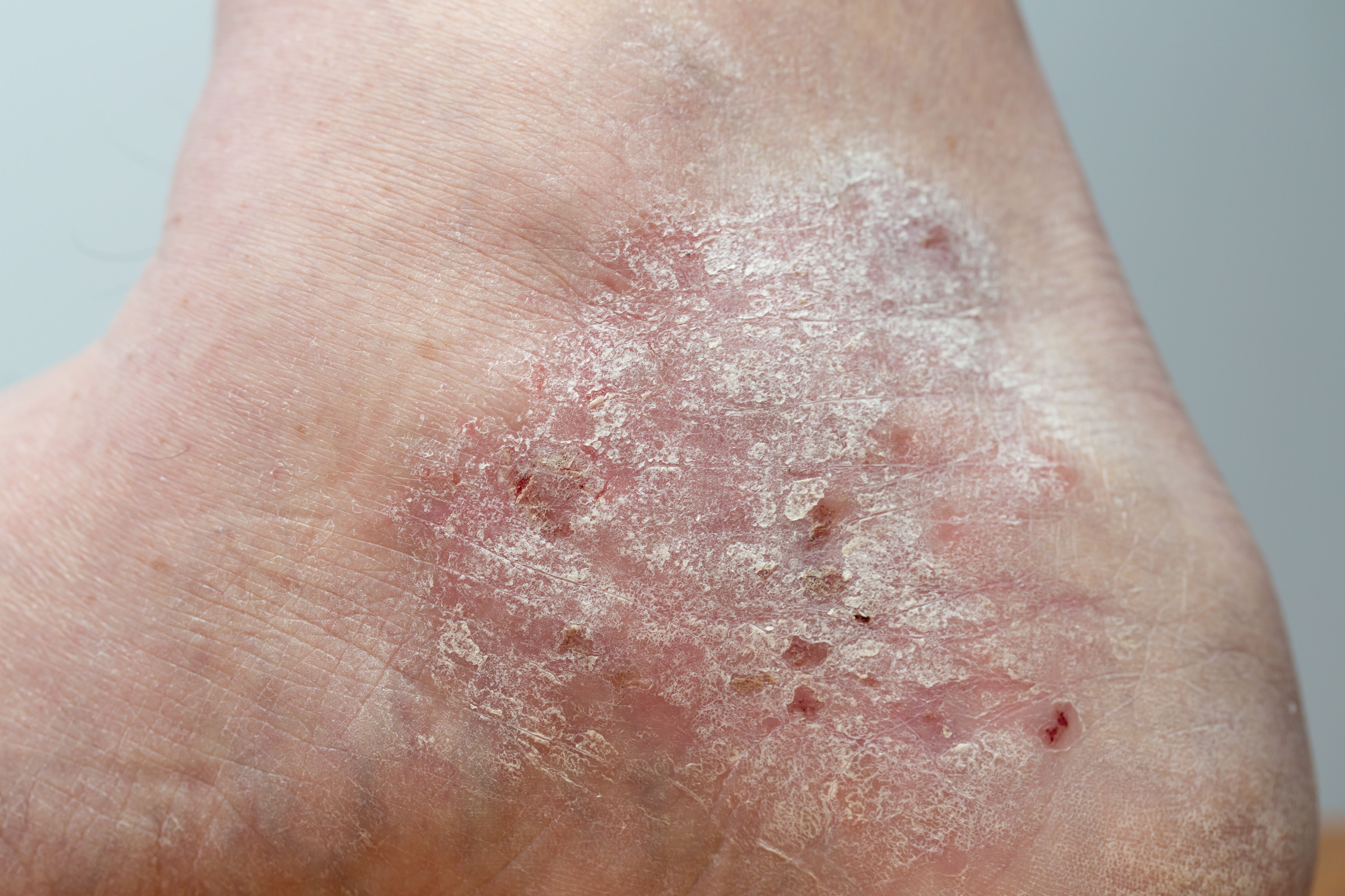 Icotrokinra Shows Durable Efficacy for PsO, Including Hard-to-Treat ...