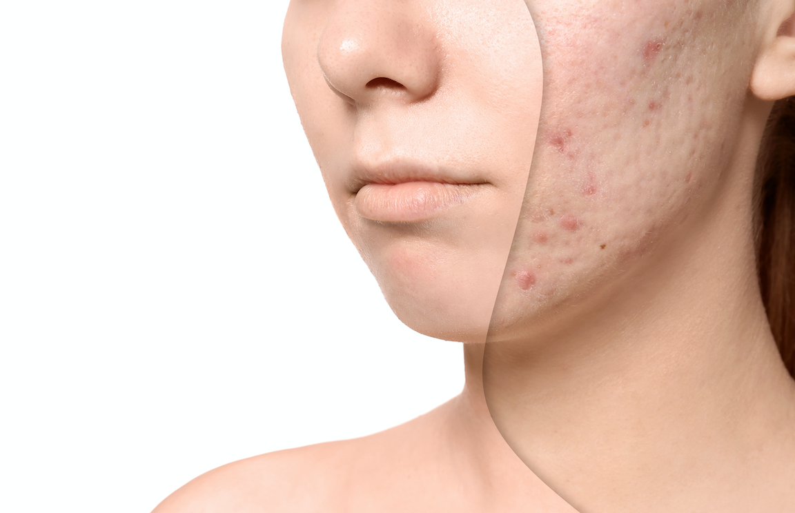 Scar Treatment Combinations