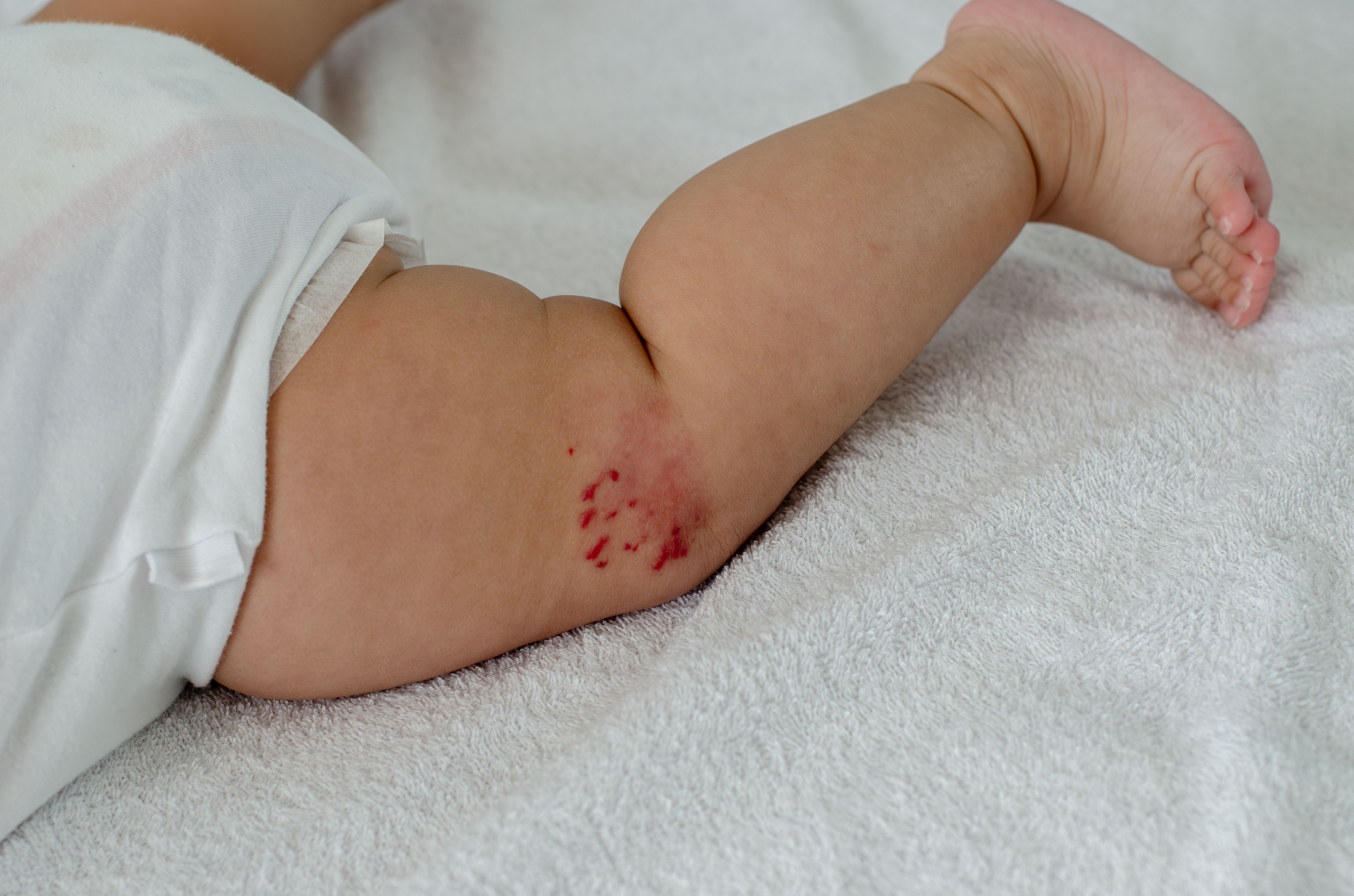 Reviewing Hemangiomas and Capillary Malformations and their Associated ...