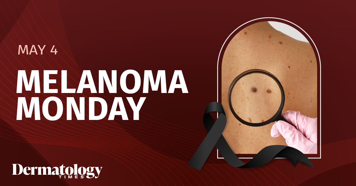 Melanoma Monday 2026: Rising Incidence Meets New Innovations in ...
