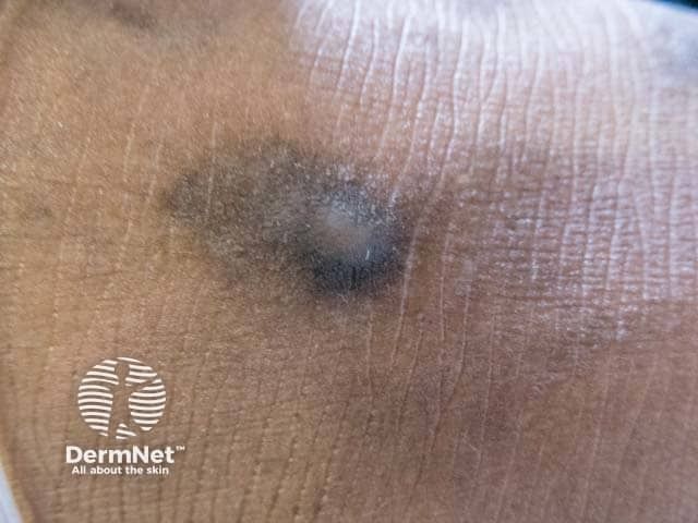 Study Reports Efficacy of Tofacinitib in Itch, Skin Infiltration ...