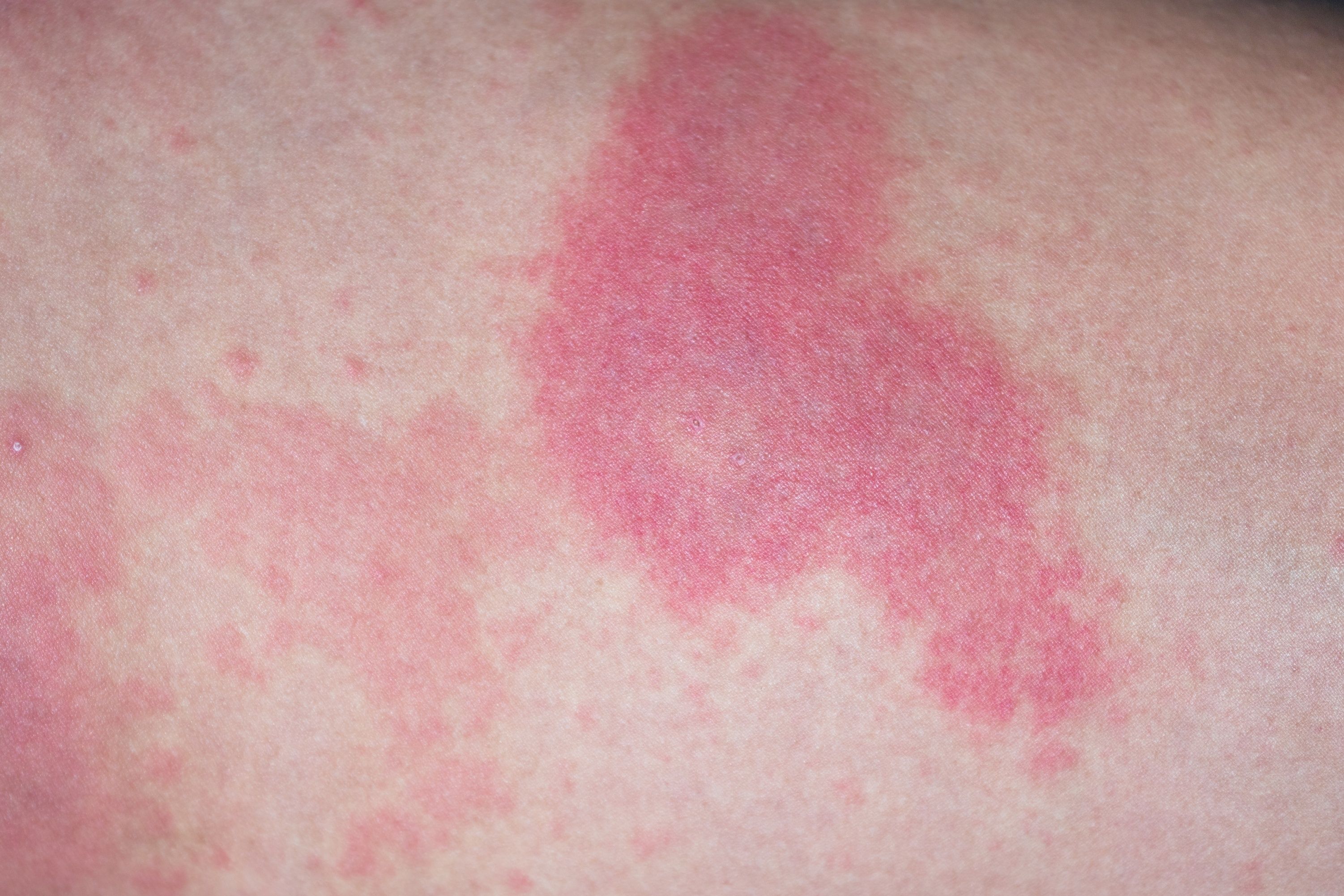 Dupilumab Efficacious In Urticaria Symptom Quality Of Life Improvement