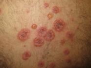 Diagnosing Treating Vesiculobullous Dermatoses