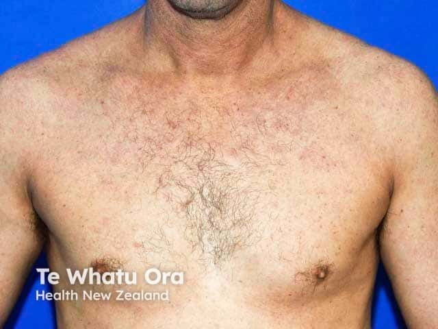 Could Twice Yearly Dosing Be Enough? Zumilokibart Data Raise the Bar ...
