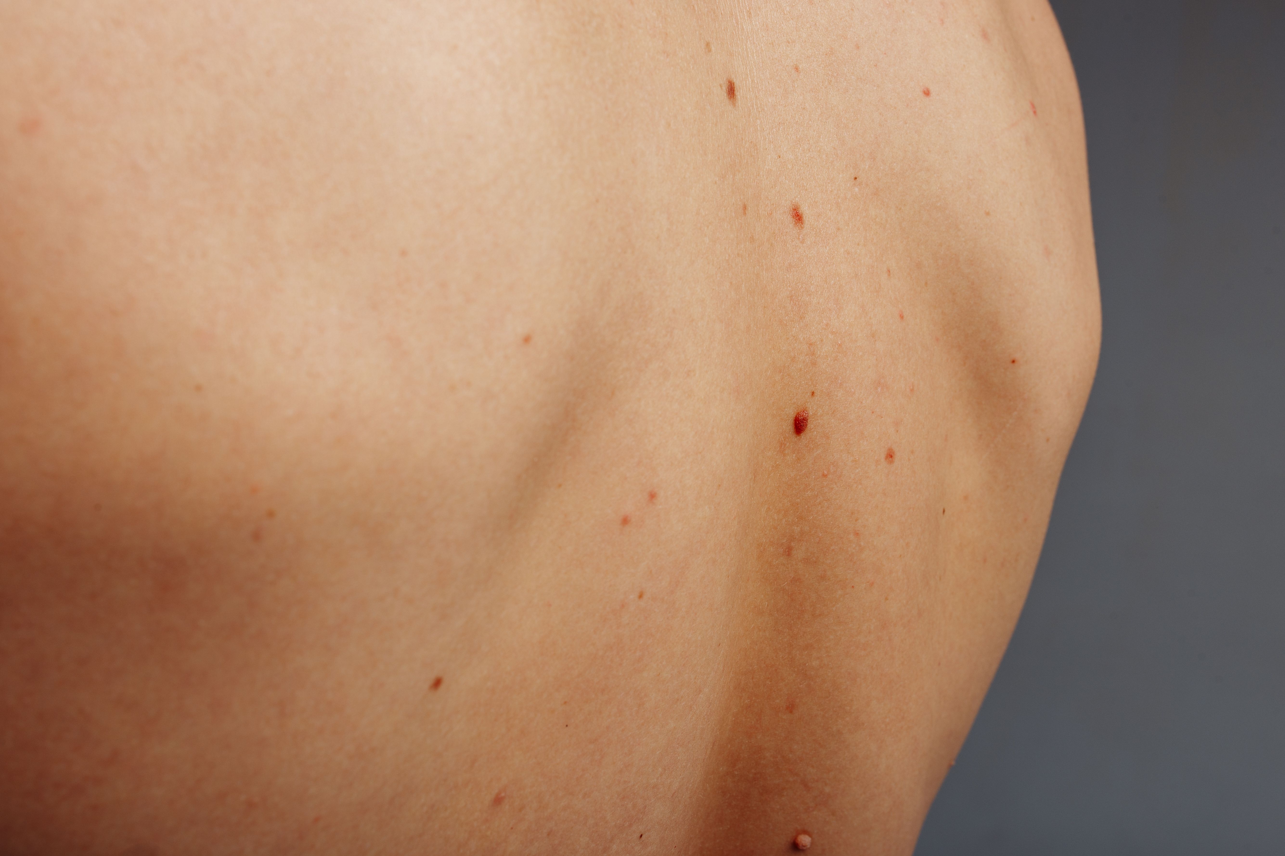 The Expanding Role of Immunotherapies for Non-Melanoma Skin Cancers ...