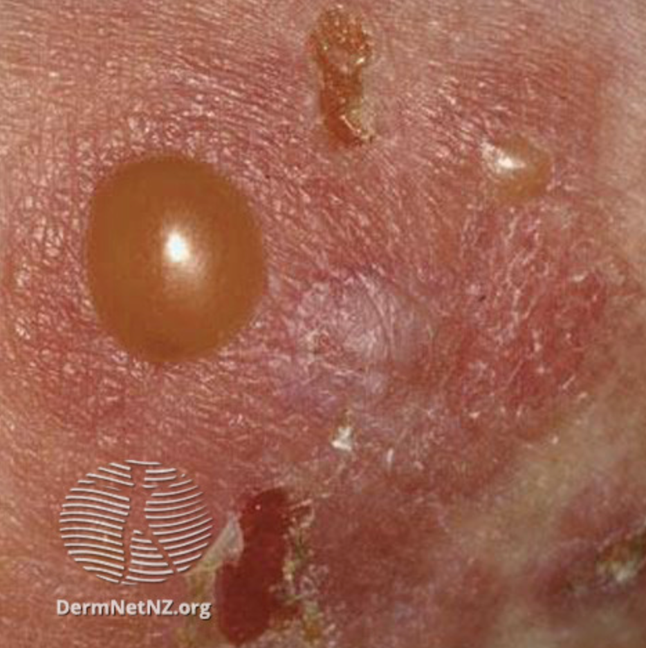 Dupilumab Successfully Treated Bullous Pemphigoid in Retrospective ...