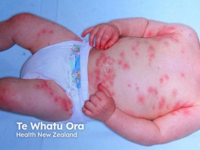 EAACI Report Explores Pediatric Chronic Urticaria Diagnosis and ...