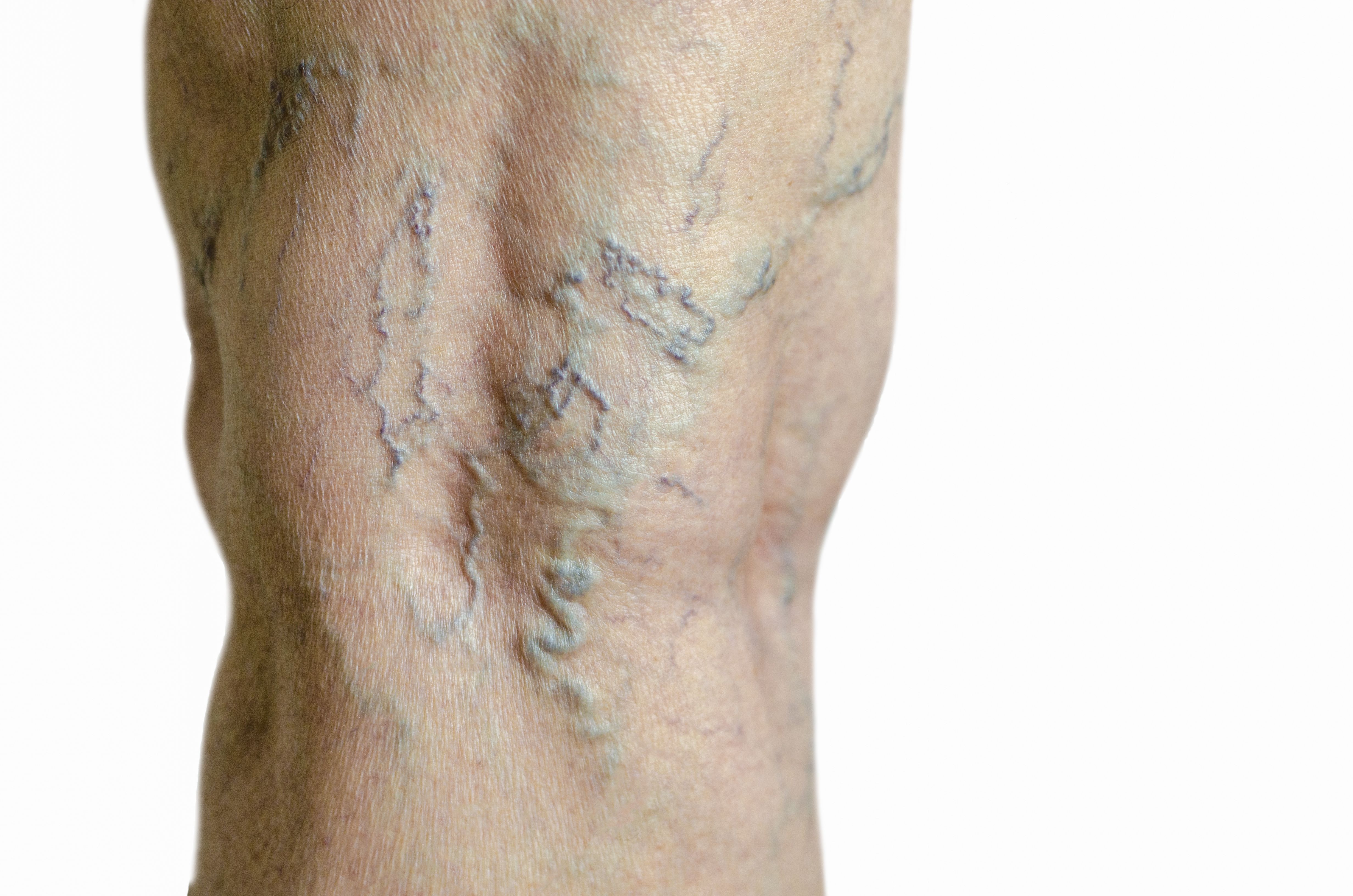 Refocusing on Venous Thromboembolism and Chronic Inflammatory Skin Diseases