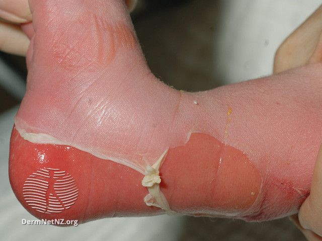 FDA Grants Priority Review of Abeona’s Pz-cel BLA for Recessive DEB ...