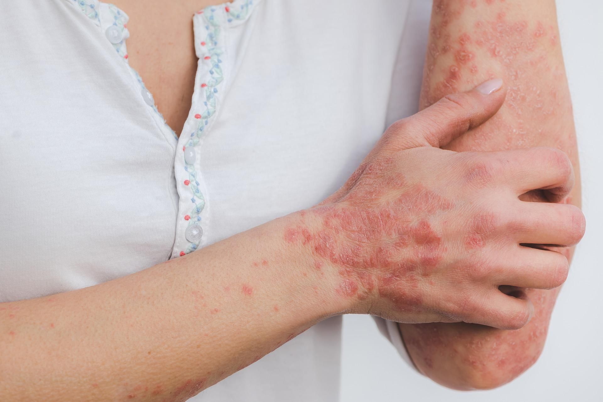 Topical Therapies for Psoriasis to Look Forward To
