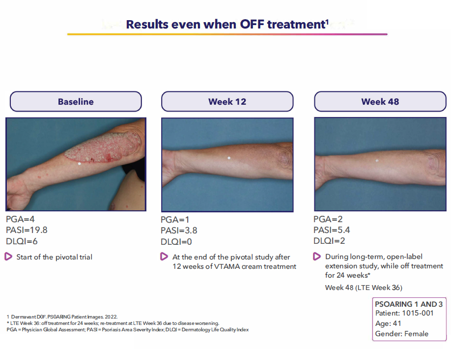 Tapinarof Cream 1% is FDA Approved