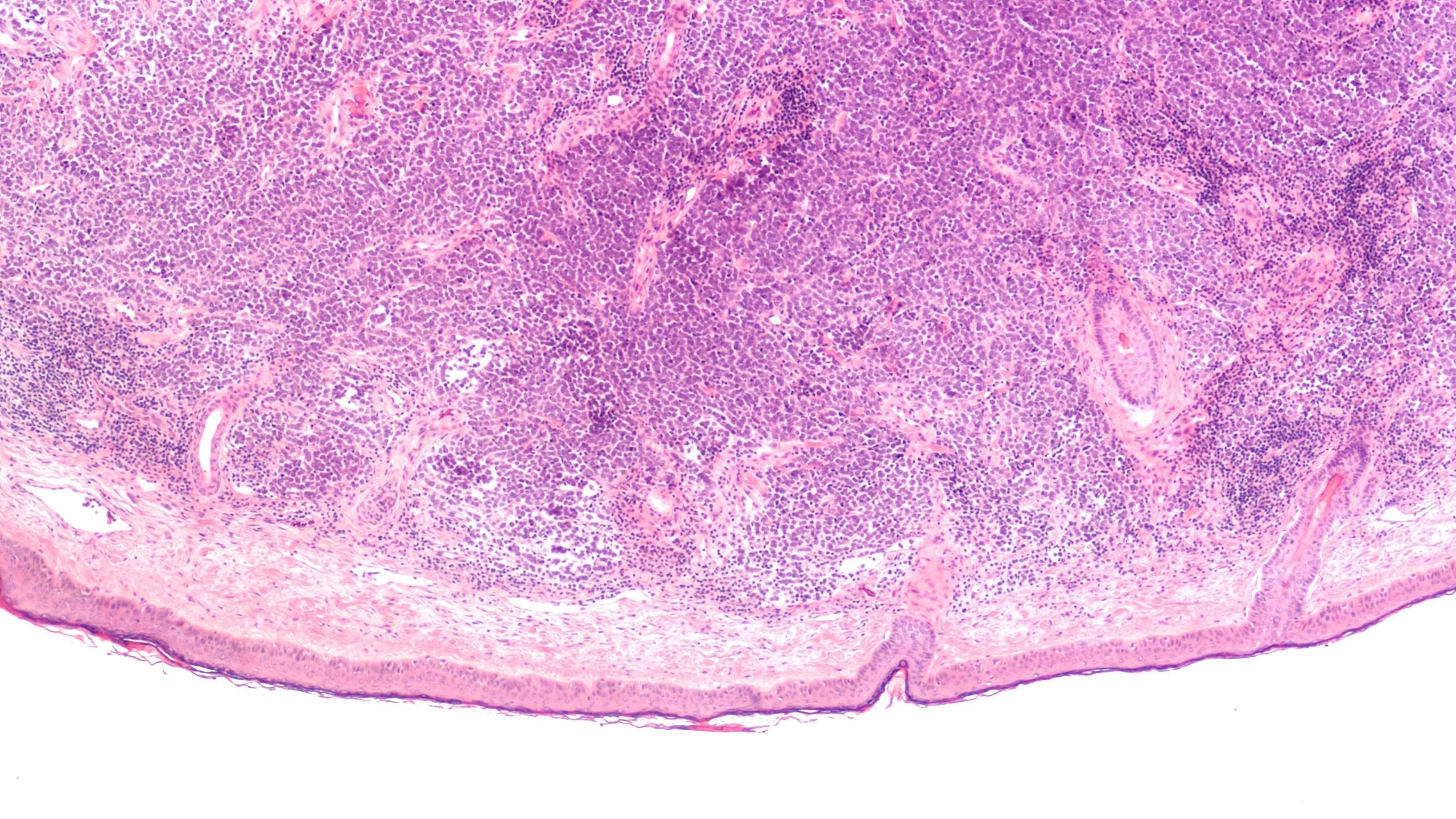 Differentiating Merkel Cell Carcinoma in Skin of Color | Dermatology Times