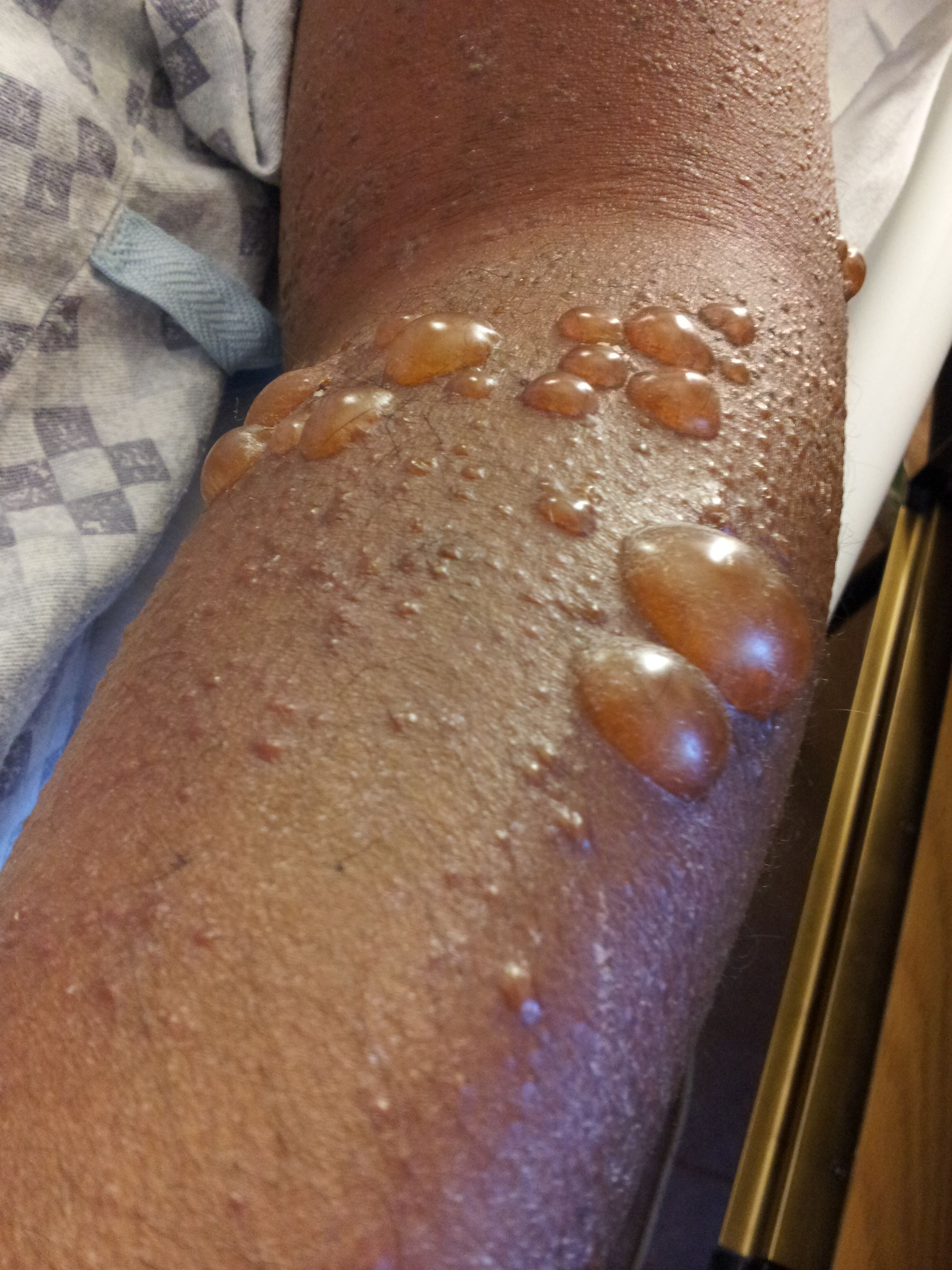 Sanofi Reports High Efficacy in Dupilumab for BP | Dermatology Times ...