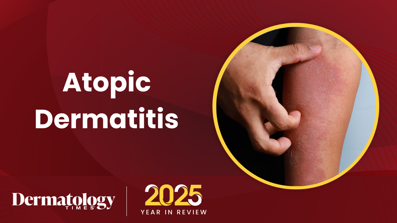 Dermatology Times 2025 Year in Review: Atopic Dermatitis | Dermatology ...