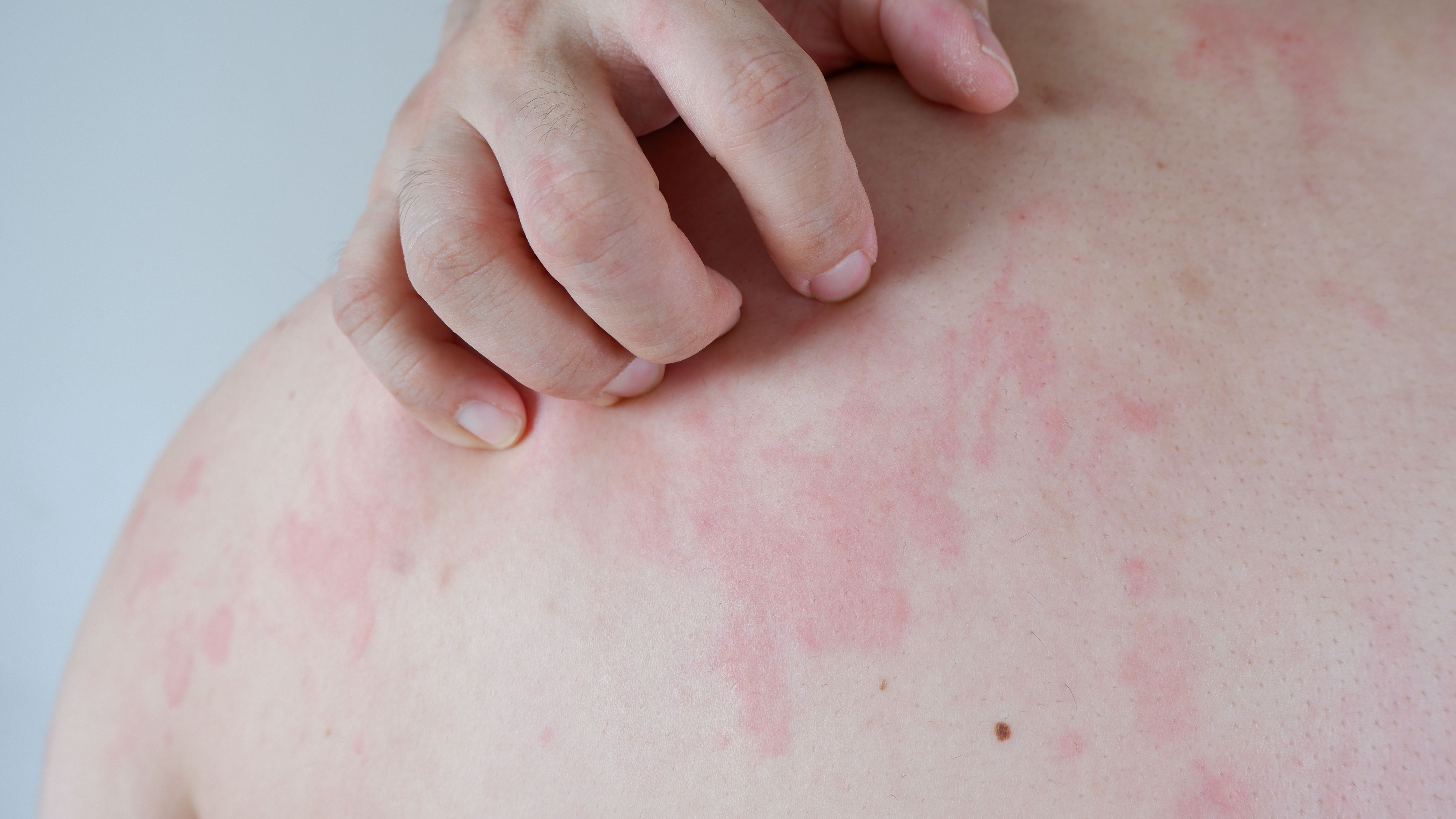 Teledermatology is Useful and Effective for Treating CSU Patients ...
