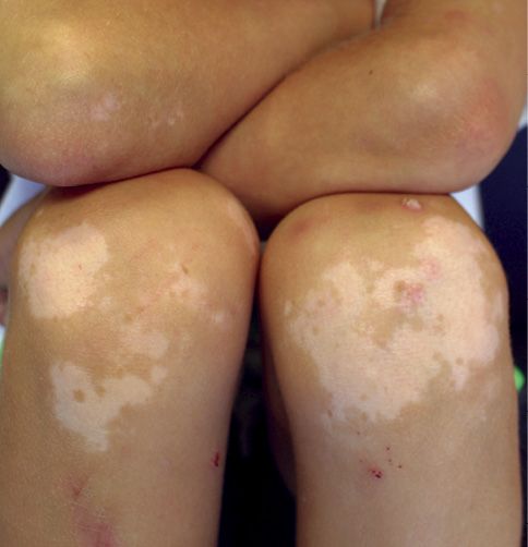 Vitiligo, Melasma, PIH, and Albinism: Clinical Update and Emerging ...
