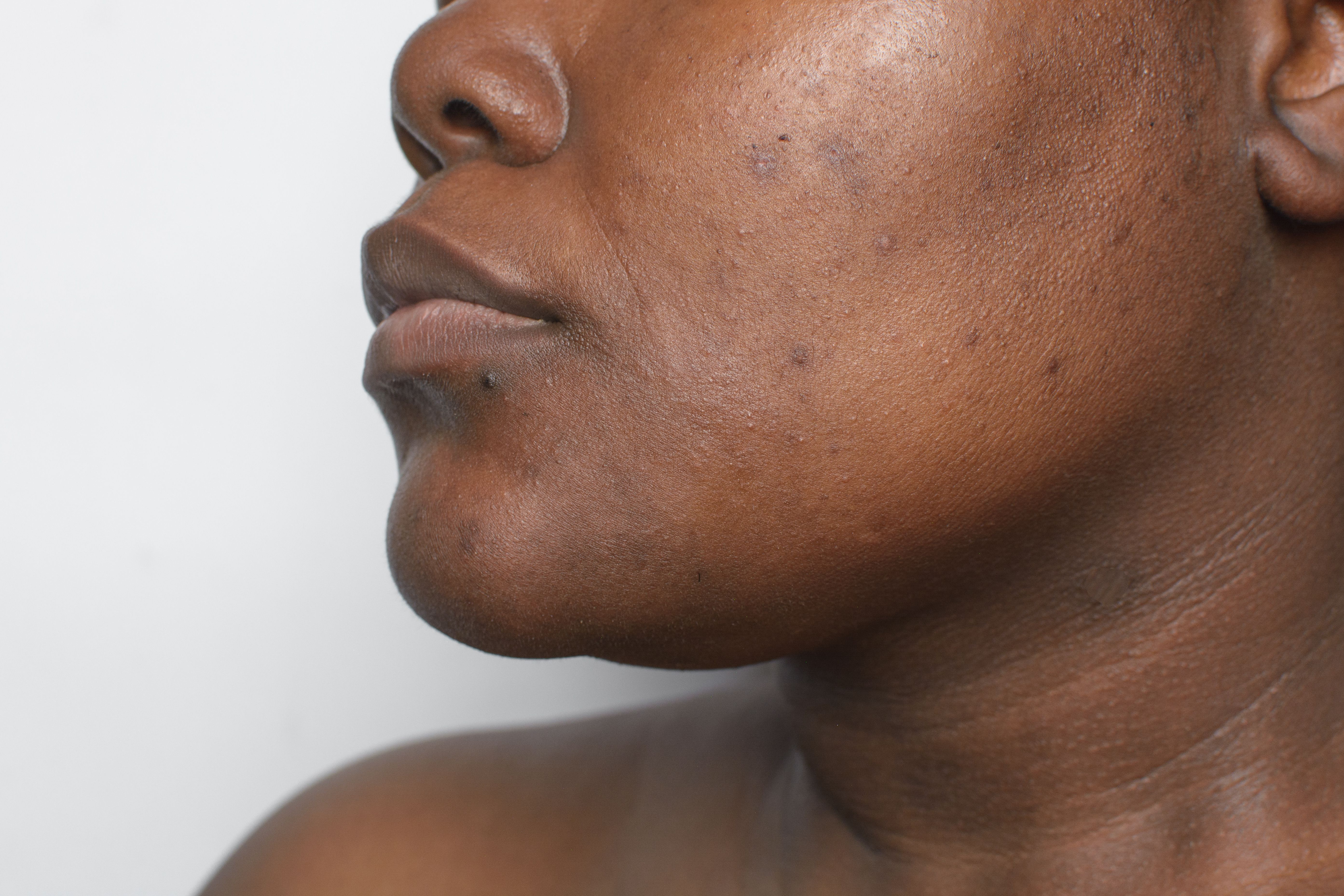 Trifarotene Yields Significant Improvements in Post-Inflammatory ...