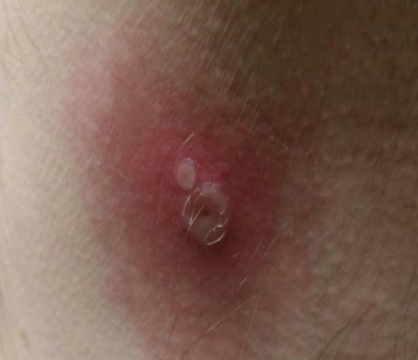 Alaskapox: What to Know About the Orthopoxvirus and the Skin Lesions it ...