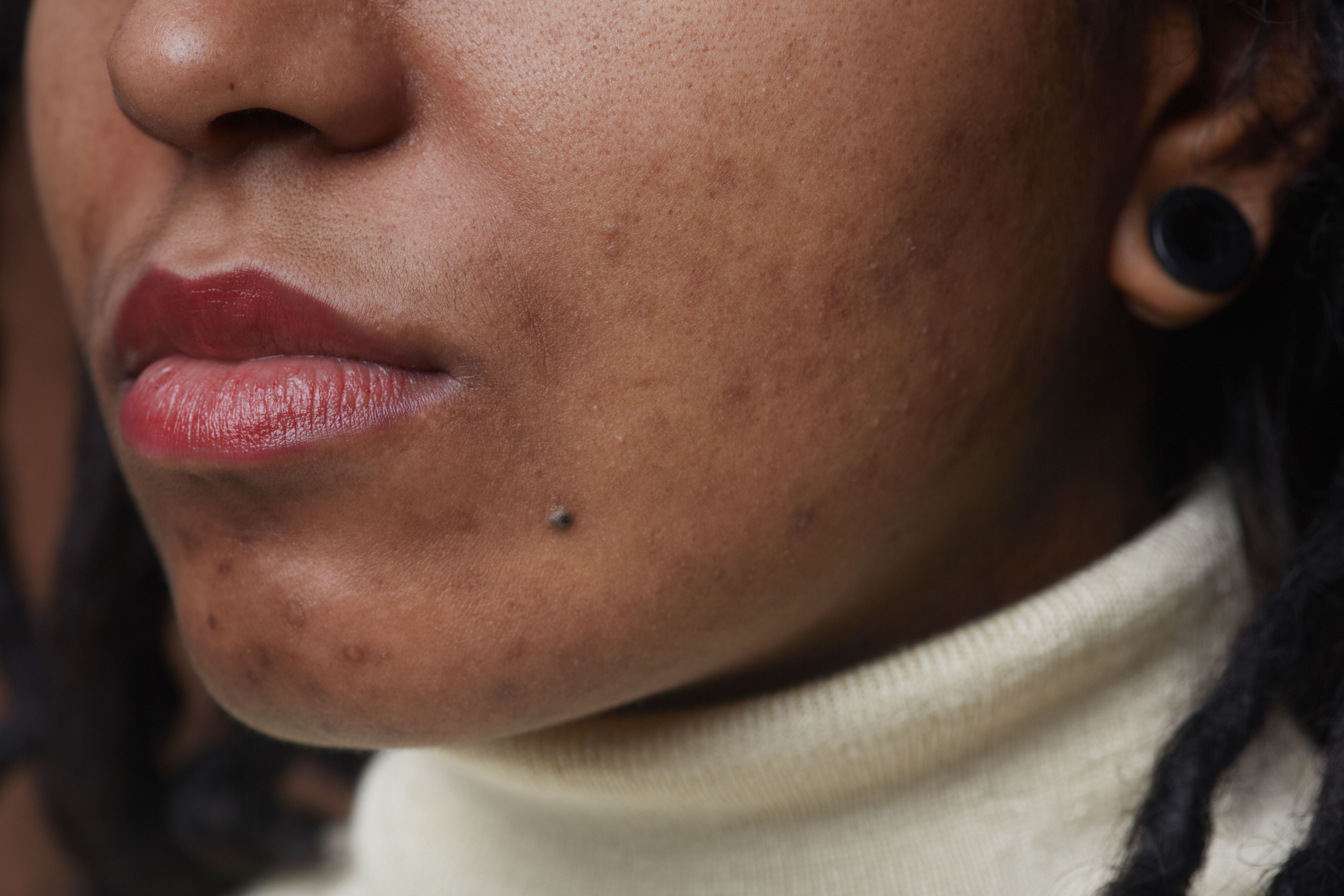 Acne in Skin of Color Patients: Preventing PIH