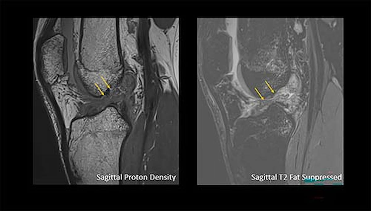 RSNA: Large Knee MRI Study Reveals Greater Incidence of ACL Tears in ...