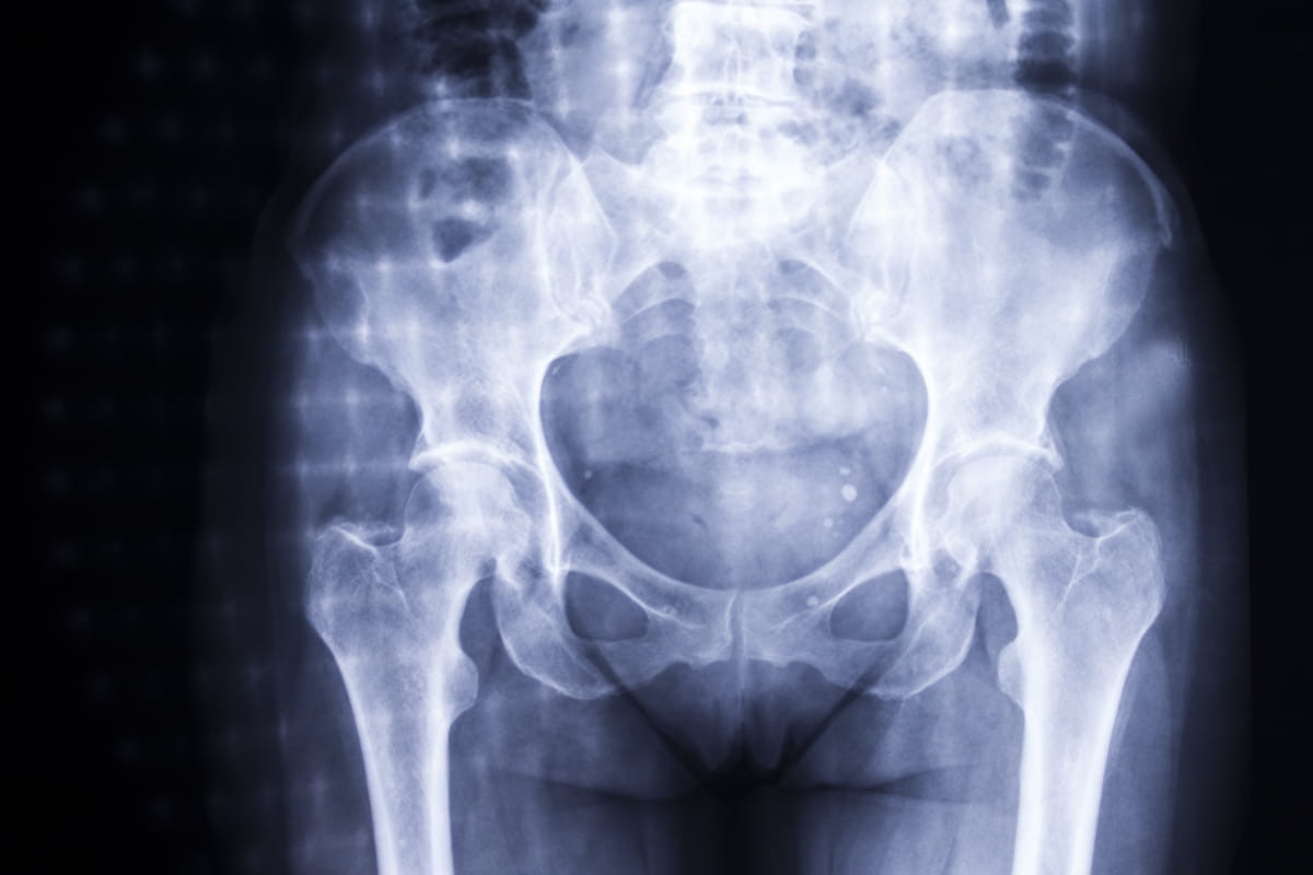 OsteoSight Gets FDA Breakthrough Device Designation for Bone Mineral ...
