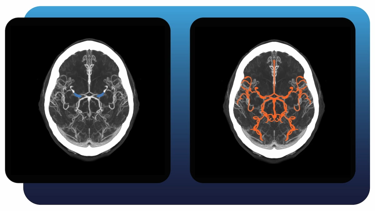 Aidoc Launches Ai Powered Neuroimaging Software For Vessel Occlusion