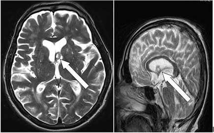 Subependymoma of Lateral Ventricle | Diagnostic Imaging