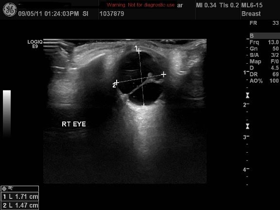 Persistent Hyperplastic Primary Vitreous (PHPV) | Diagnostic Imaging