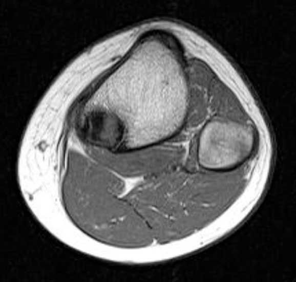 Nonossifying Fibroma (Fibroxanthoma)