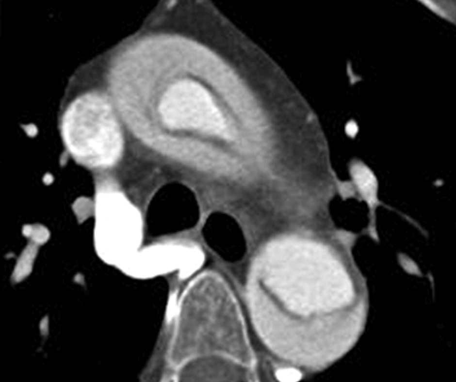 Ai Powered Algorithm May Enhance Ct Assessment Of Aortic Dissection