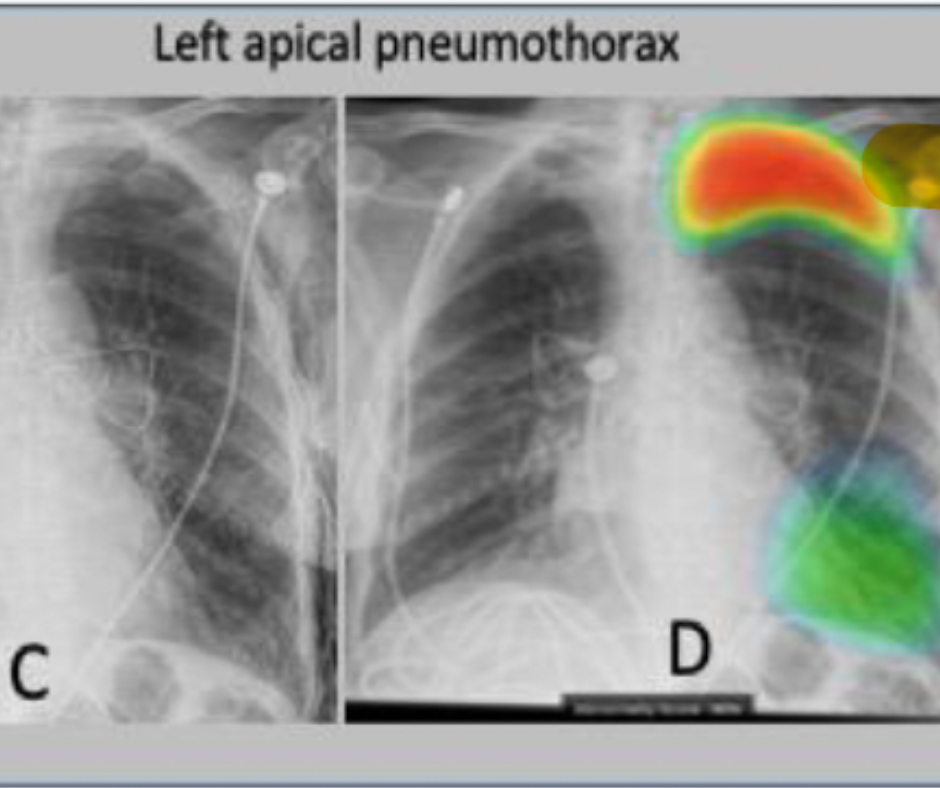 Qureai Ai For Chest Xrays