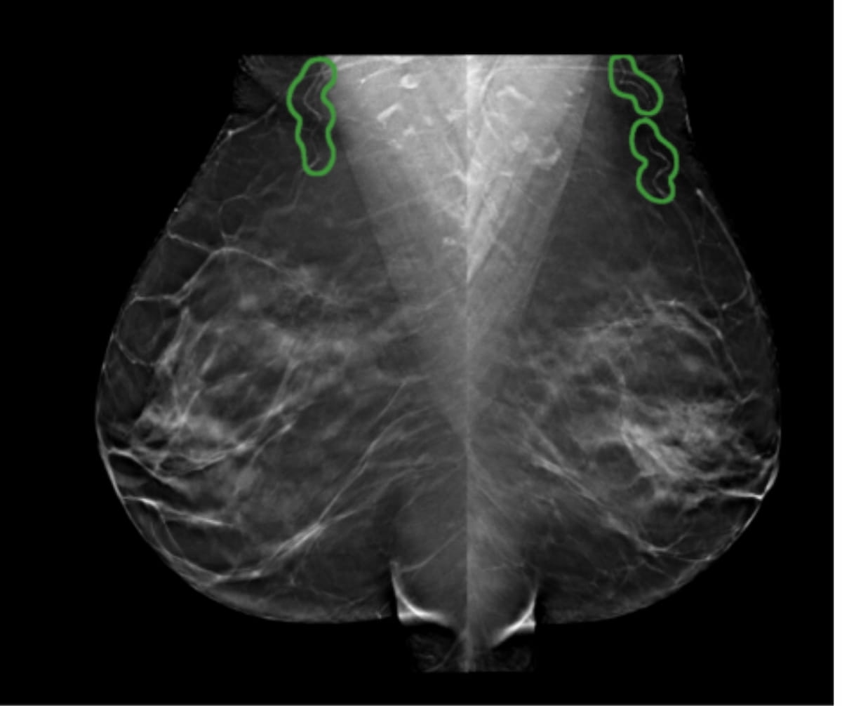 Mammography News Fda Clears Ai Software For Breast Arterial Calcification Detection