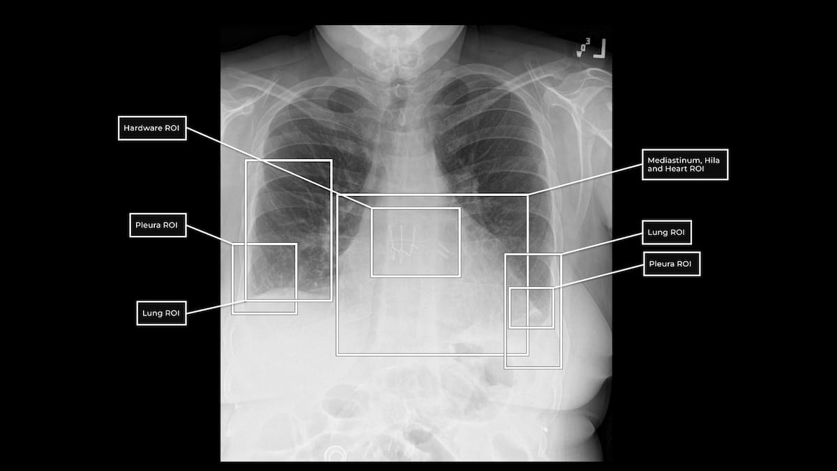 FDA Clears Emerging AI-Powered CXR Software from Qure.ai | Diagnostic ...