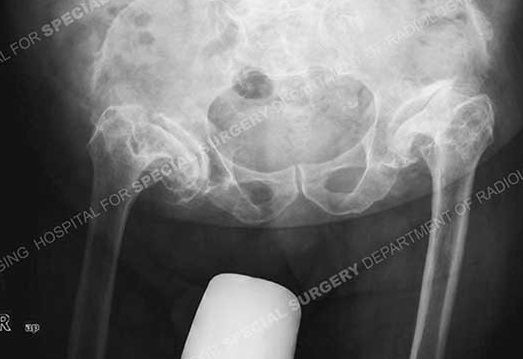 Spondyloepiphyseal Dysplasia Dwarfism