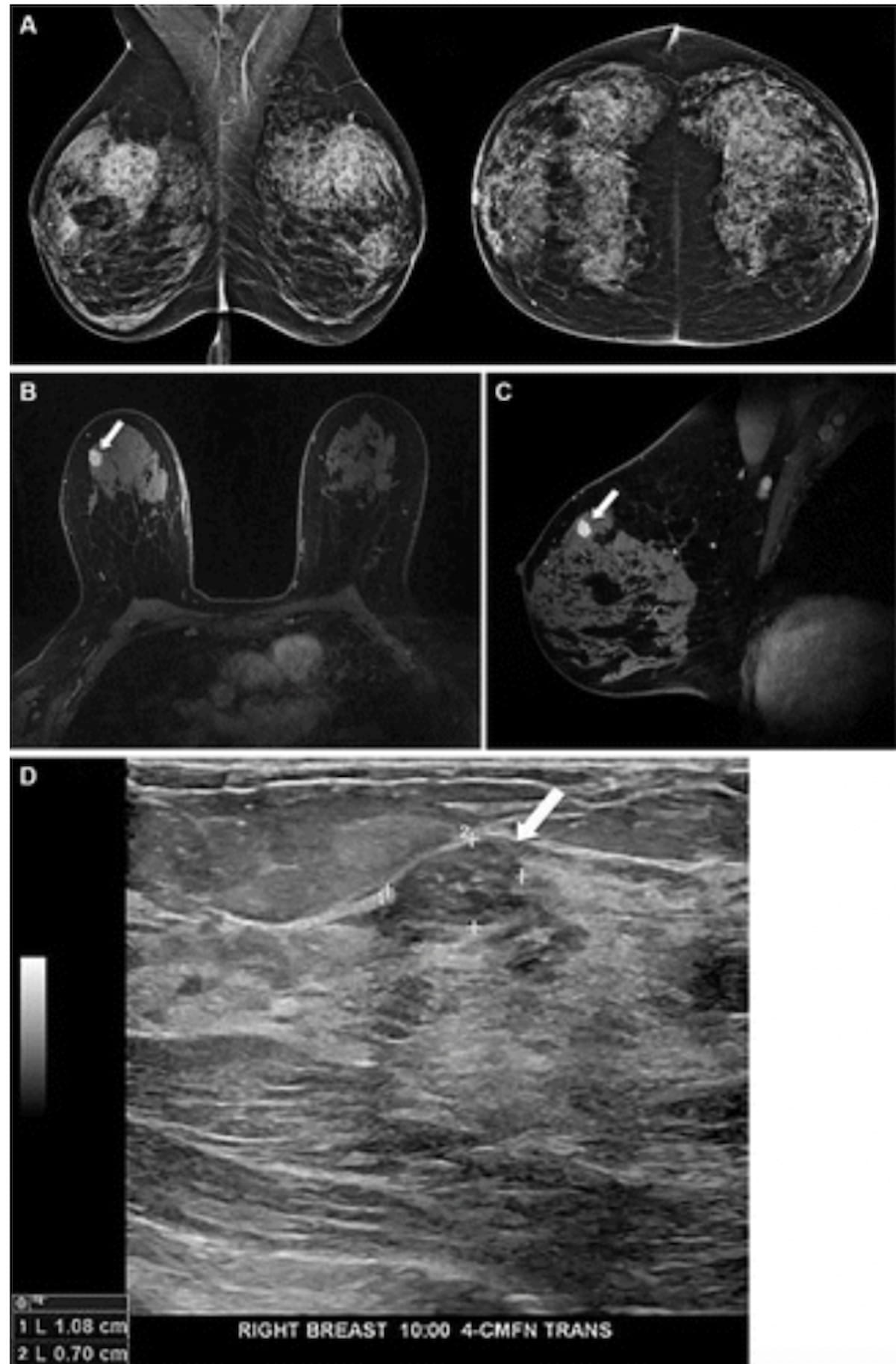 Mammography Based Deep Learning Model Facilitates Higher Breast Cancer Detection On Screening Mri