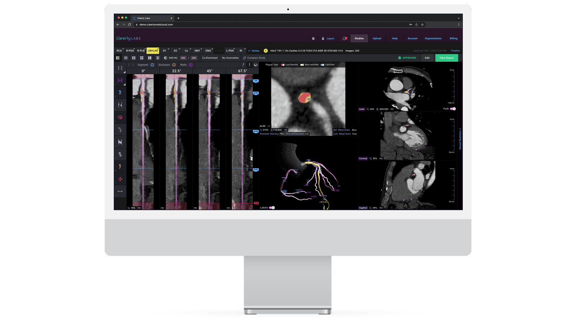 New Software Facilitates Use of Coronary CT Angiography Scans in ...
