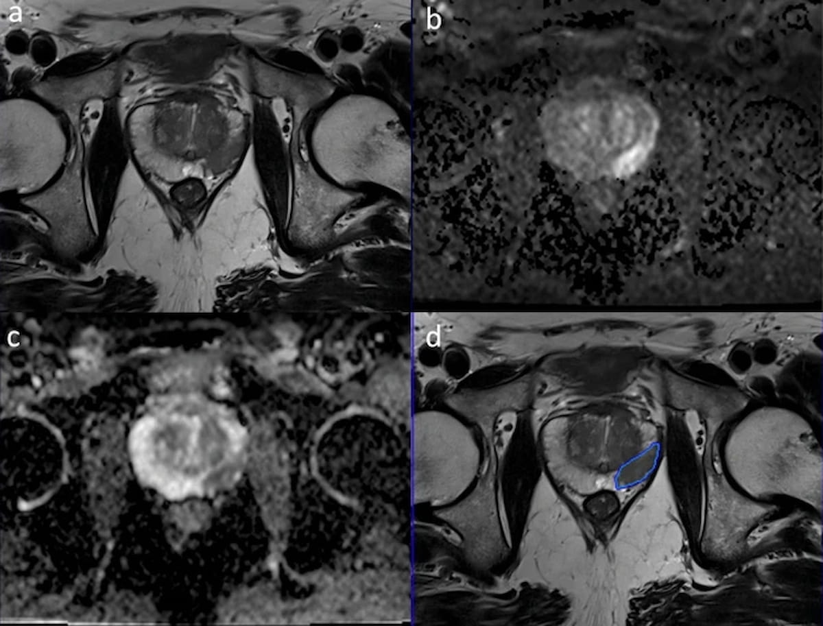 Deep Learning Network Shows Significant Potential for Prostate Cancer ...