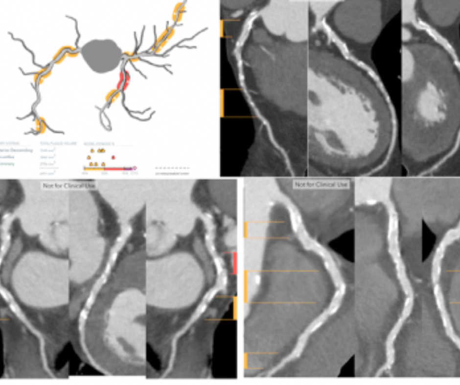 HeartFlow Garners FDA Clearances for Two AI-Powered Assessment Tools ...