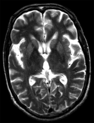 Creutzfeldt Jakob’s Disease