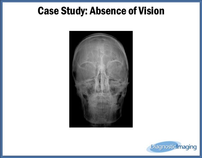 Absence of Vision