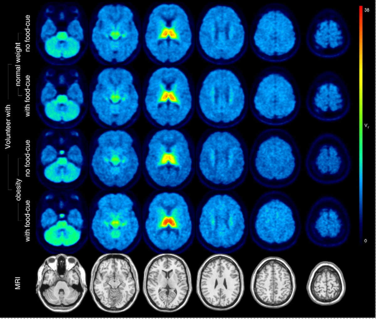 Can Molecular Imaging Provide Key Insights on Obesity Interventions?