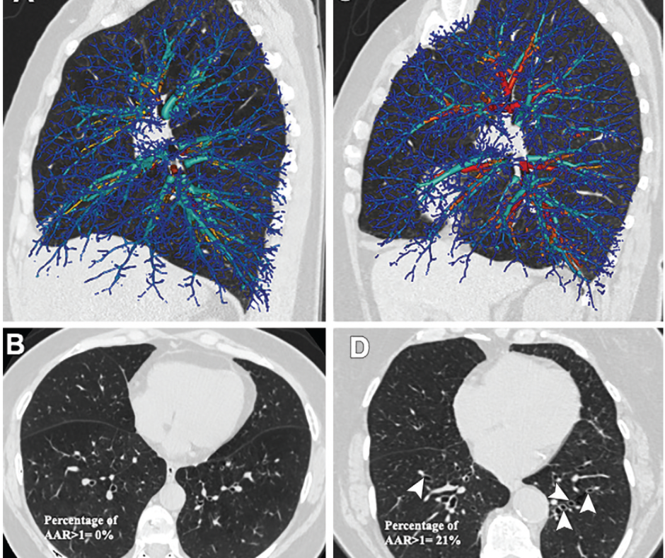 Study Says AI Can Enhance Chest CT Assessment of Bronchiectasis in Ever ...