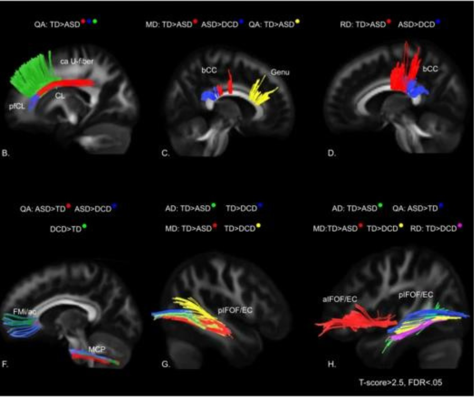 New MRI Study Identifies Signature White Matter Connectivity Patterns ...