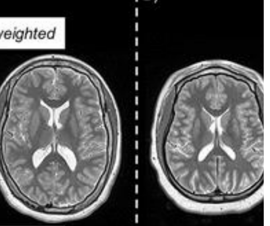 Study Says Quantitative MRI Can Detect Biomarkers of Neurological ...