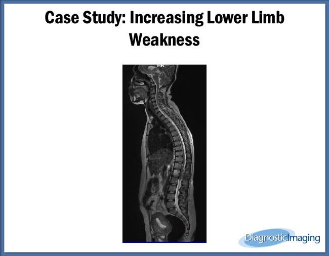 Increasing Lower Limb Weakness increasing-lower-limb-weakness